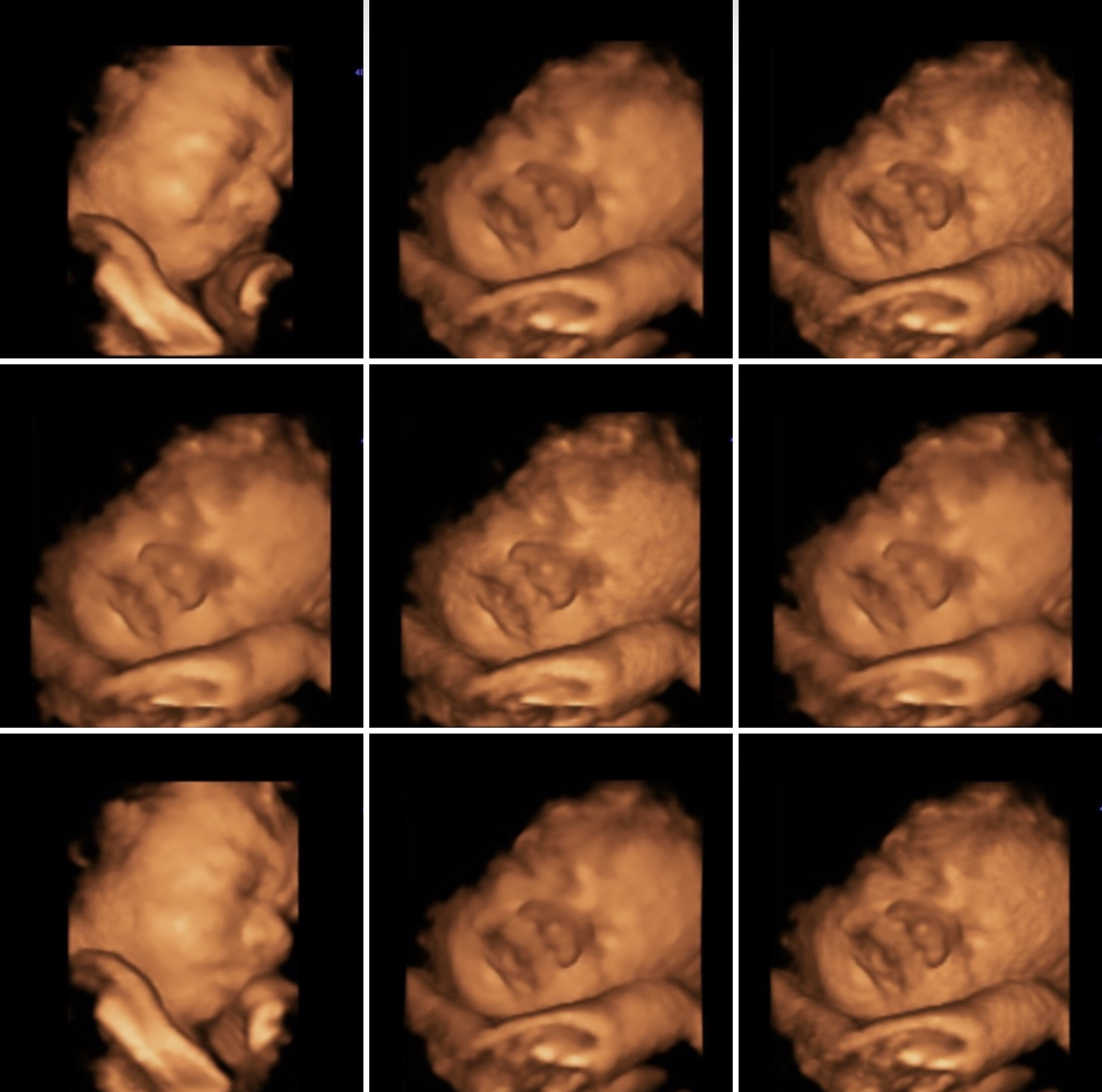 Fetal Imaging 3D/4D Live